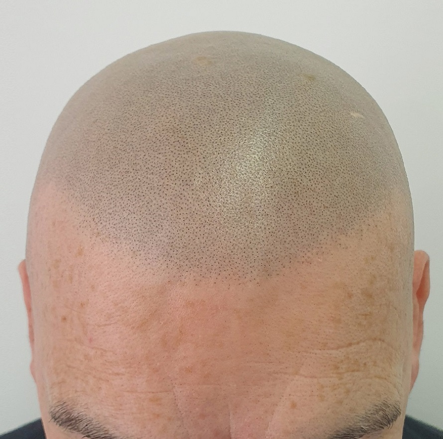 Scalp Micropigmentation Hairline Service Newmarket ON